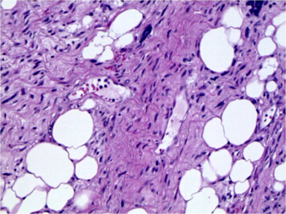 Dedifferentiated Liposarcoma Pathology Outlines - Dedifferentiated liposarcoma